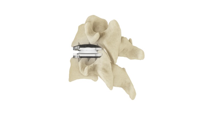 Centinel Spine Marks 100th prodisc C Vivo Implant - ODT