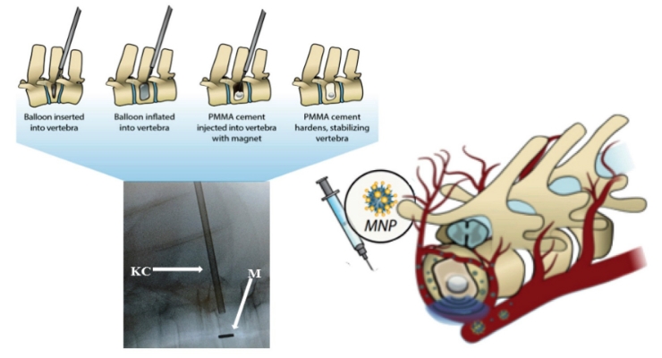 Surgical Cement Heals Spinal Fractures with Magnetic, Targeted Drug ...