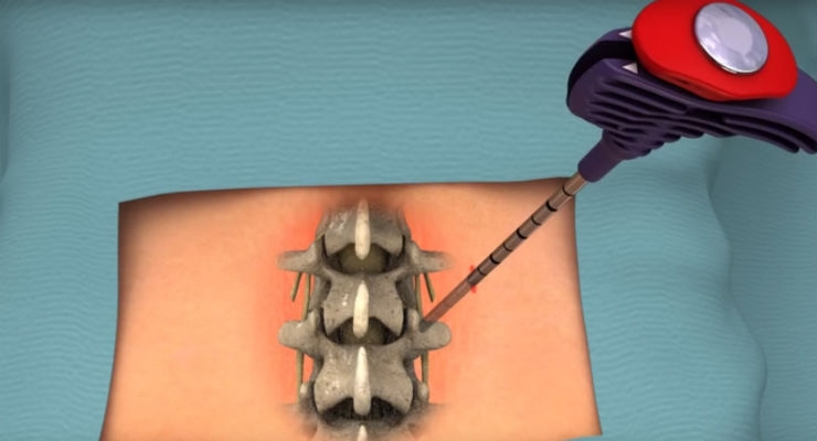 FDA Clears Intraosseous Nerve Ablation System for Chronic Low Back Pain ...