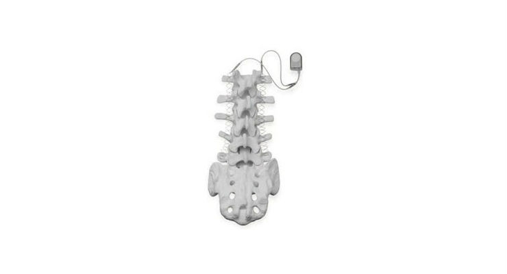 Zimmer Biomet Recalls Implantable Spinal Fusion Stimulators - ODT