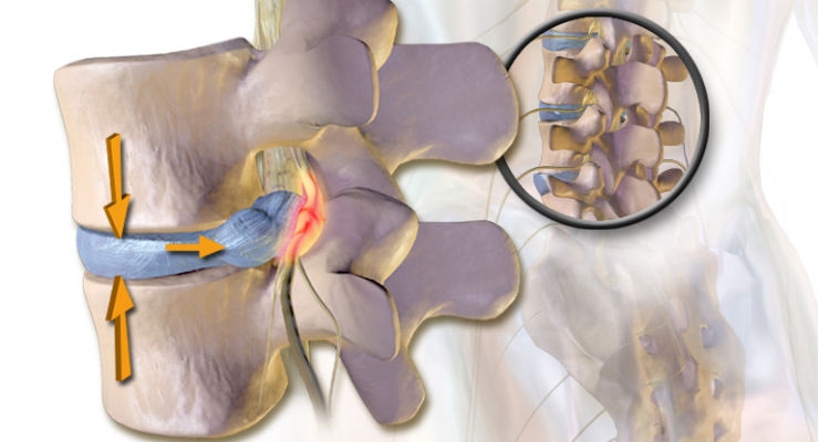 Innovative Tissue Engineering Strategies to Repair Spinal Disc ...