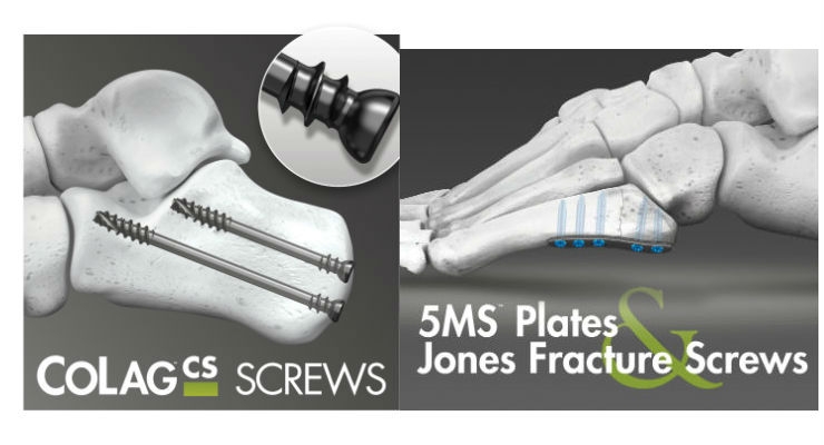 FDA Clears In2Bones USA's Foot Fracture and Correction System - ODT