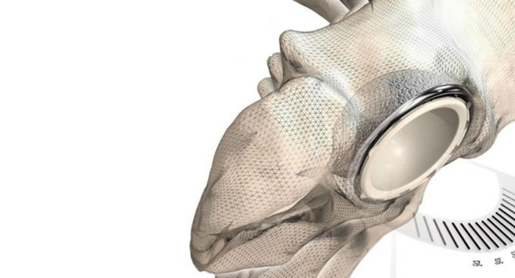 Patient-Specific Simulation Breakthroughs for Total Hip Replacements - ODT