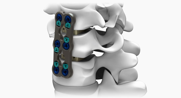 Life Spine Gears Up for Gruve Anterior Cervical Plate System Release - ODT