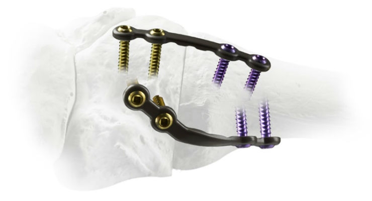 FDA Clears Lapiplasty 3D Bunion Correction System for Pediatric ...