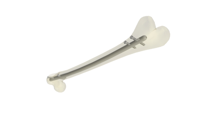 OIC Launches Femur Nail - ODT