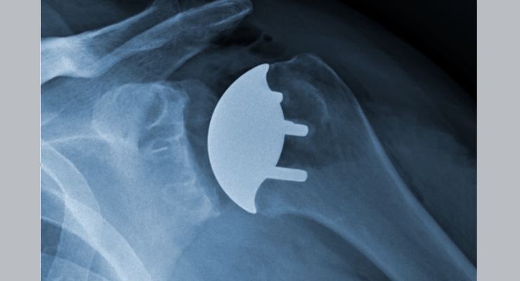 Study: Catalyst CSR Total Shoulder Improves Accuracy and Precision in ...