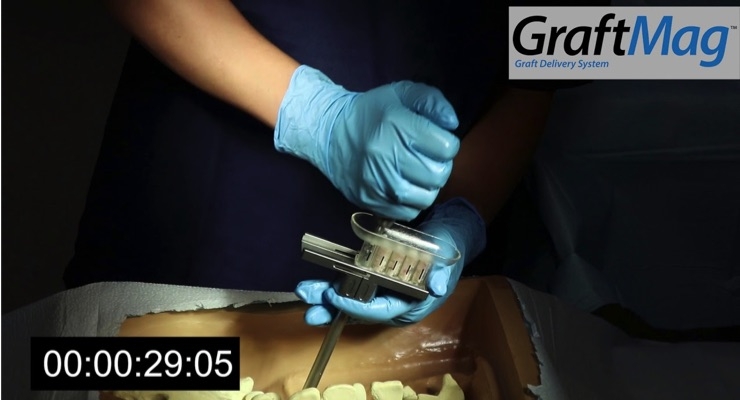 Spine Wave Announces the Commercial Launch of the GraftMag Graft ...