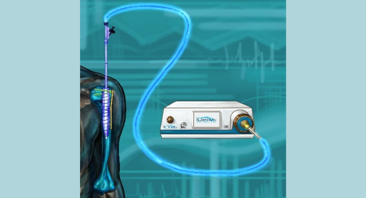 FDA Clears IlluminOss's New Light Console for Implants - ODT