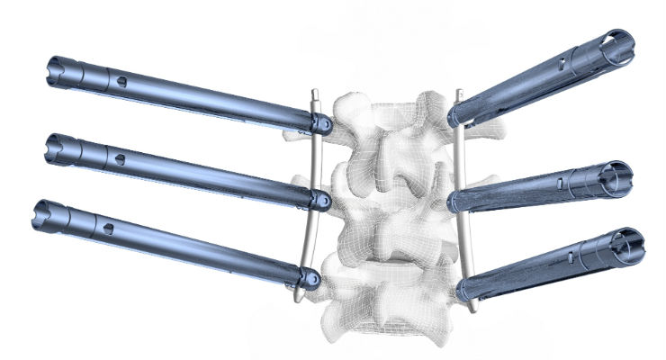 CoreLink Expands MI Portfolio With Tiger MIS Extended Tab Pedicle Screw ...