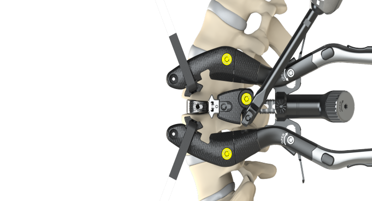 Comprehensive Tool Set Key to Lateral Access Spine Surgery Success - ODT