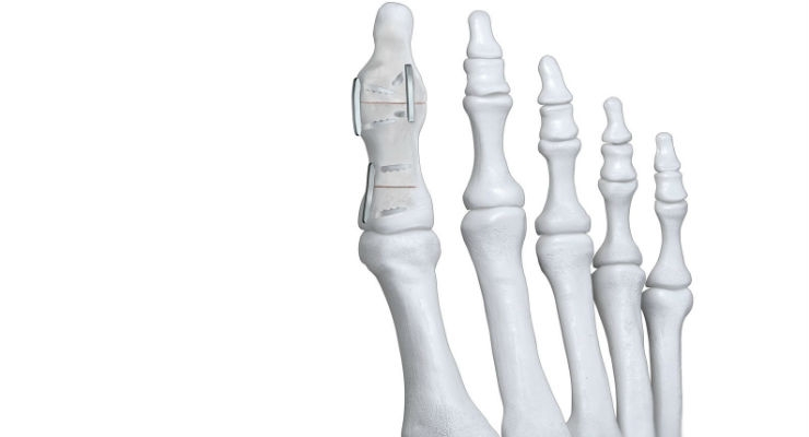 Paragon 28 Launches Nitinol Staple System for Fracture & Osteotomy Foot ...