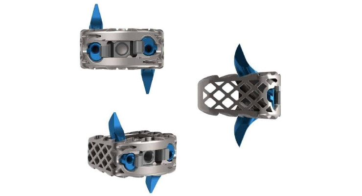 Genesys Spine Launches 3D-Printed Cervical Stand-Alone Cage - ODT