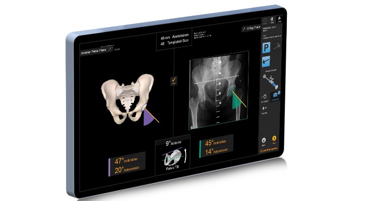 Smith+Nephew's RI.HIP NAVIGATION Study Results Show Promise - ODT