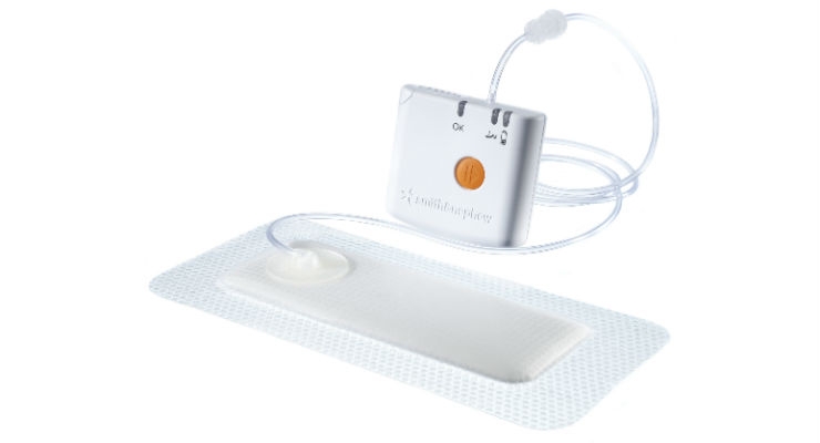 Smith & Nephew's PICO Therapy Reduces Complications Following ...