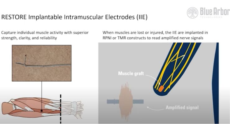 Blue Arbor Gets FDA Breakthrough OK for Neuromuscular Interface - ODT