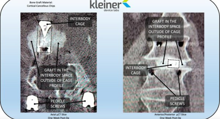 Kleiner Device Labs Completes 50th Case With KG2 Surge Interbody System ...