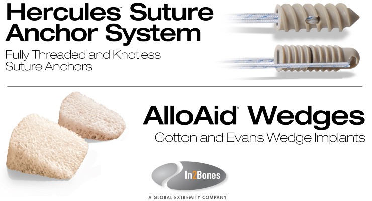 In2Bones Launches Hercules Suture Anchors, AlloAid Wedges - ODT