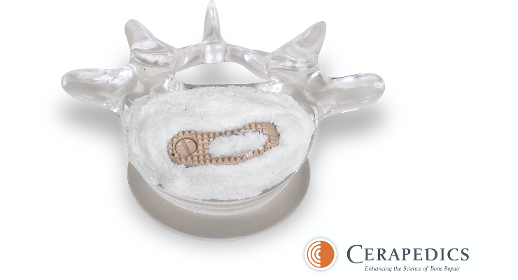 FDA Grants Breakthrough Device Designation to Cerapedics’ P-15L Bone ...