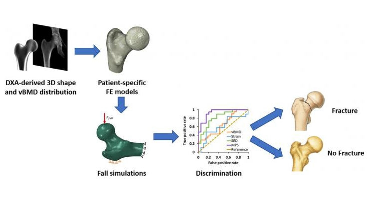 3D Bone Densitometry Simulation Better Predicts Osteoporosis Fracture ...