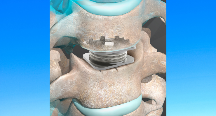 Orthofix Publishes Five-Year Data for M6-C Artificial Cervical Disc - ODT
