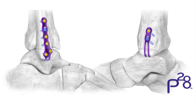 Paragon 28 Adds Hook Plates to Gorilla Ankle Fracture Plating System - ODT