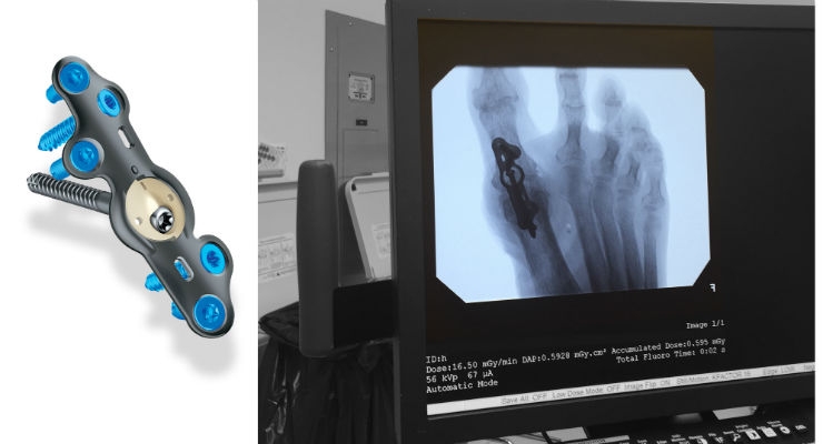 FDA Clears In2Bones' CoLink View 'See-Through' Plating System - ODT