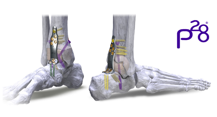 Paragon 28 Launches Silverback Span Plating System - ODT