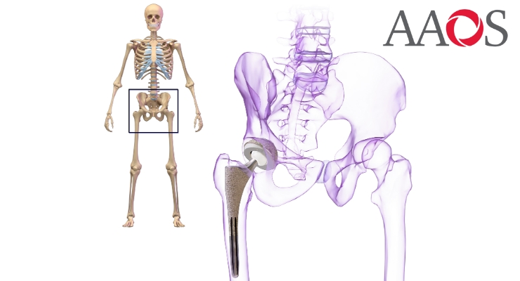 AAOS: 'Dual Mobility' Hip Replacement Reduces Risk of Dislocation - ODT