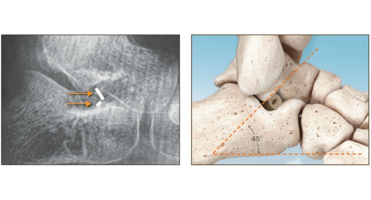 In2Bones Launches 'See-Through' PitStop Subtalar PEEK Implant - ODT