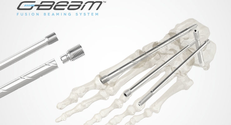 FDA Clears Orthofix's G-Beam Fusion Beaming System - ODT