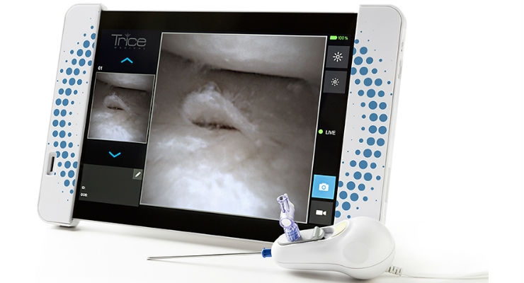 Trice Medical's Portable, In-Office Arthroscopy System Gains CE Mark ...