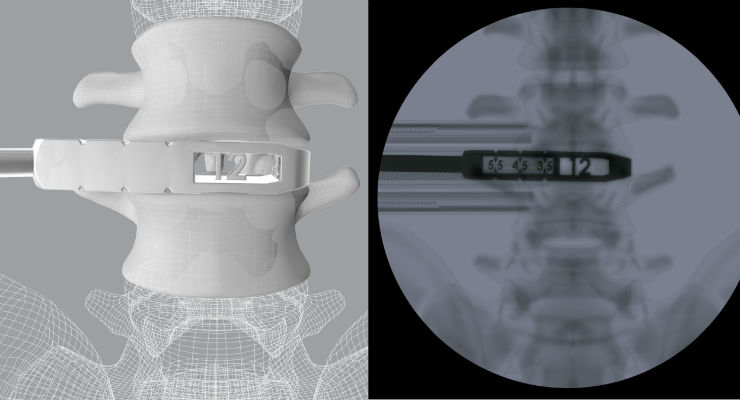 CoreLink Releases Oblique Lumbar Interbody Fusion Instrument Set - ODT