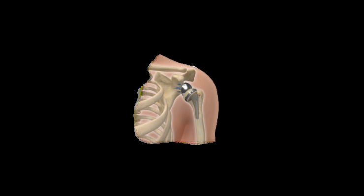 AAOS: Nearly All Shoulder Replacement Patients Under Age 55 Return to ...
