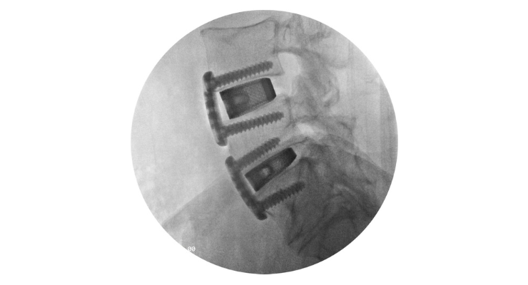 Zavation Introduces 2-Screw ALIF Plating System - ODT