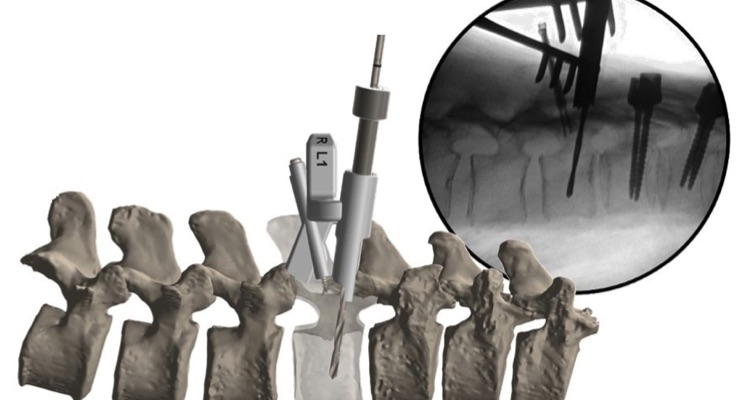 OrthoPediatrics Marks 1,000th Case Using FIREFLY Pedicle Screw Guides - ODT