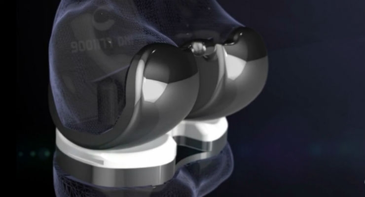 AAOS News: Customized Posterior-Stabilized Knee Replacement System ...