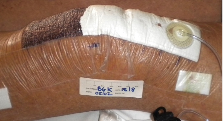 Analysis Shows Effectiveness of PICO NPWT in Helping to Prevent ...