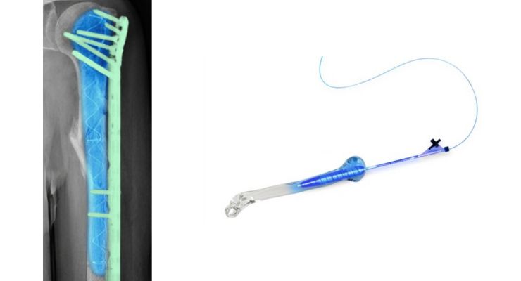 IlluminOss Medical Light-Cured Implants Used in 10,000 Surgeries - ODT