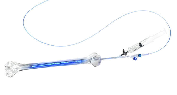 IlluminOss Bone Stabilization System Launched in U.S. for Fragility ...