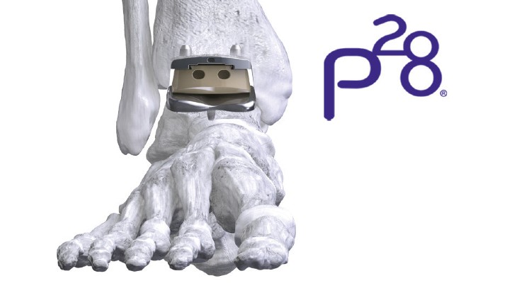 FDA OKs Paragon 28's APEX 3D Total Ankle Replacement System - ODT