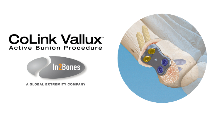 In2Bones Releases CoLink Vallux Active Bunion Procedure - ODT