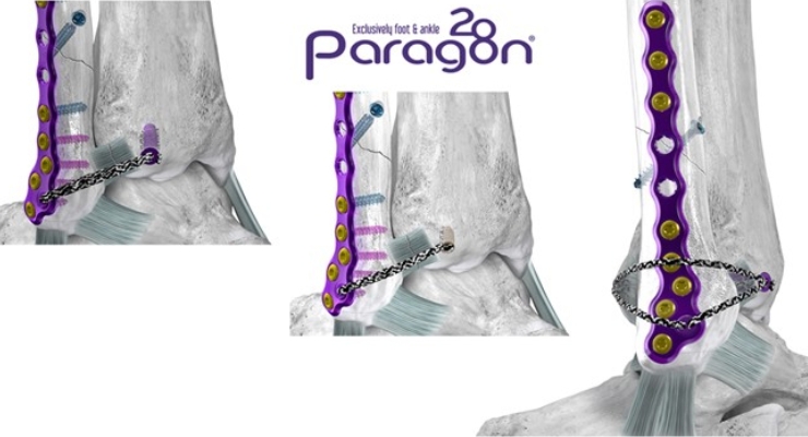 Paragon 28 Launches Grappler R3INFORCE Extraosseous Repair - ODT