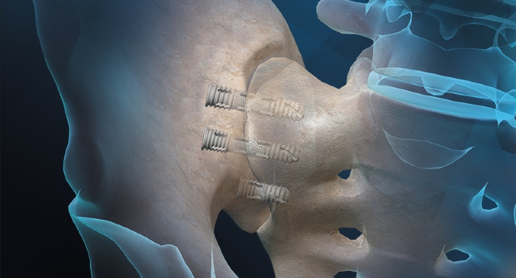 FDA Clears Orthofix's Firebird SI Fusion System - ODT