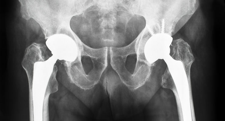 Cementless Hip Implants Are Gradually Losing Their Popularity in Europe ...