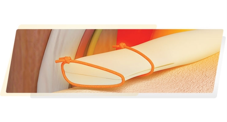 FDA Clears Ceterix Orthopaedics' New Suture Cartridge for Mensical ...
