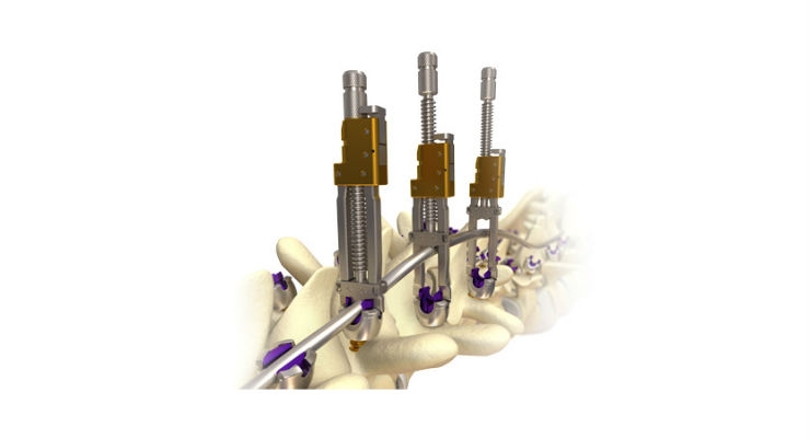 K2M Launches New Surgical Solutions to Enhance MESA 2 Deformity Spinal ...