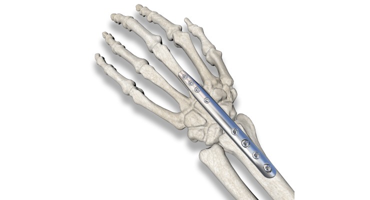 Children's Anatomies Complicate Orthopedic Implant Design - ODT