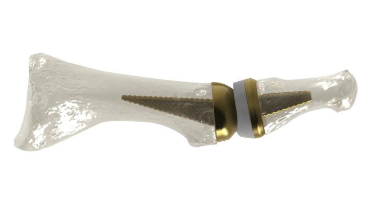 AAOS24: First 3D Printed Toe Joint Replacement Being Showcased - ODT