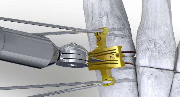 Paragon 28 Launches Lapidus Cut Guide System to Control Bone Resection ...